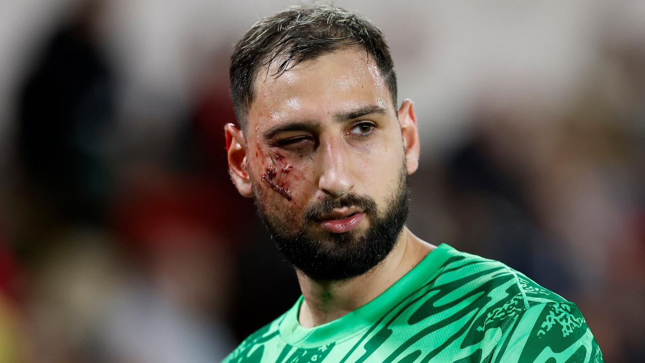 Stollen im Gesicht: Donnarumma mit schweren Schnittverletzungen ...